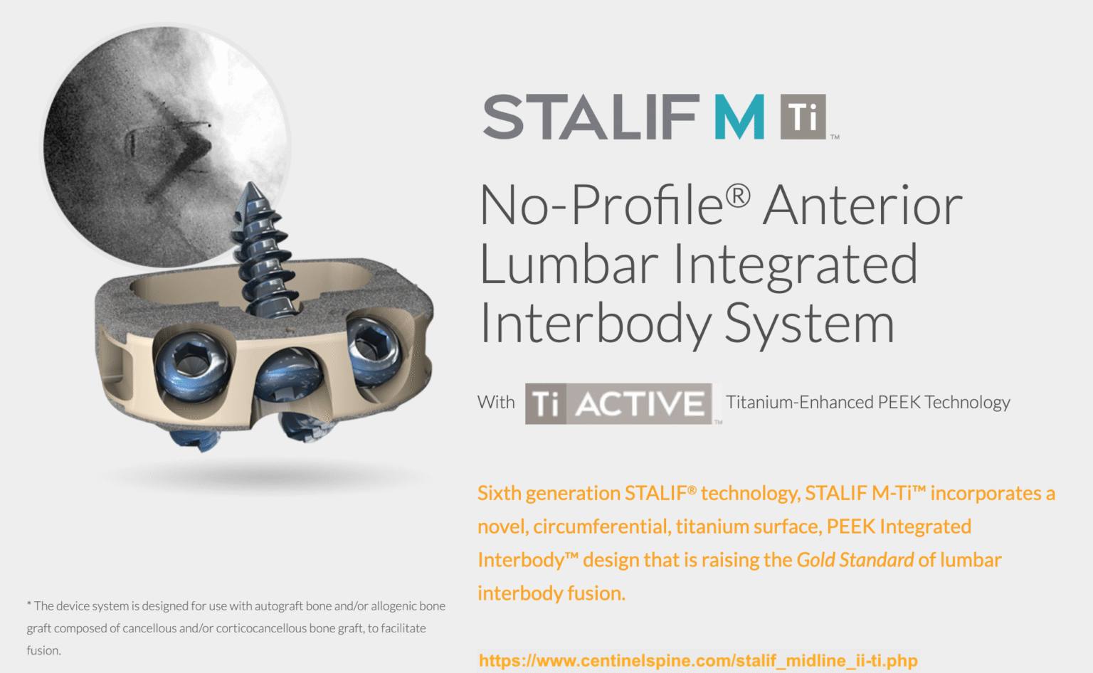 Revolutionizing Spine Surgery: The STALIF® Integrated Interbody ...